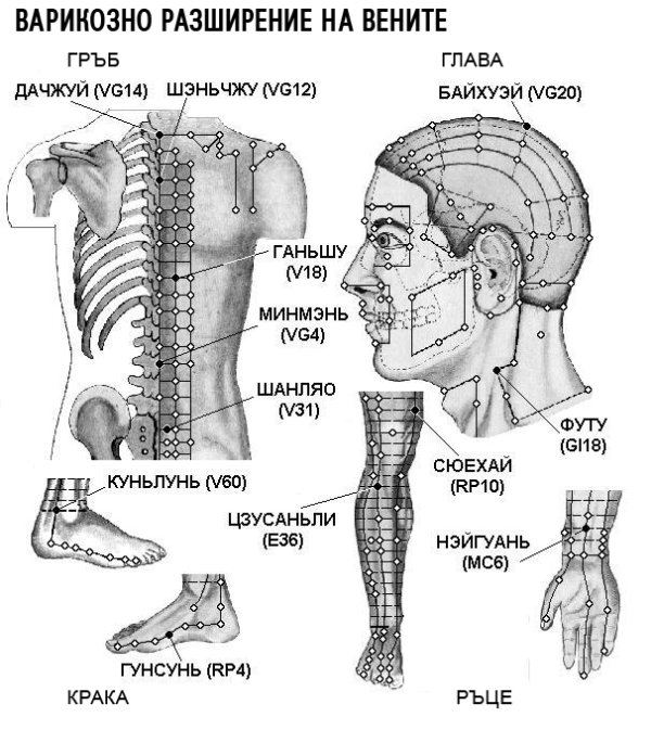ВАРИКОЗНО РАЗШИРЕНИЕ НА ВЕНИТЕ